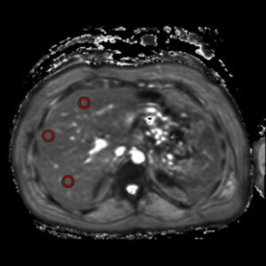 MRI Diagnostics – Partners Advanced Liver Imaging